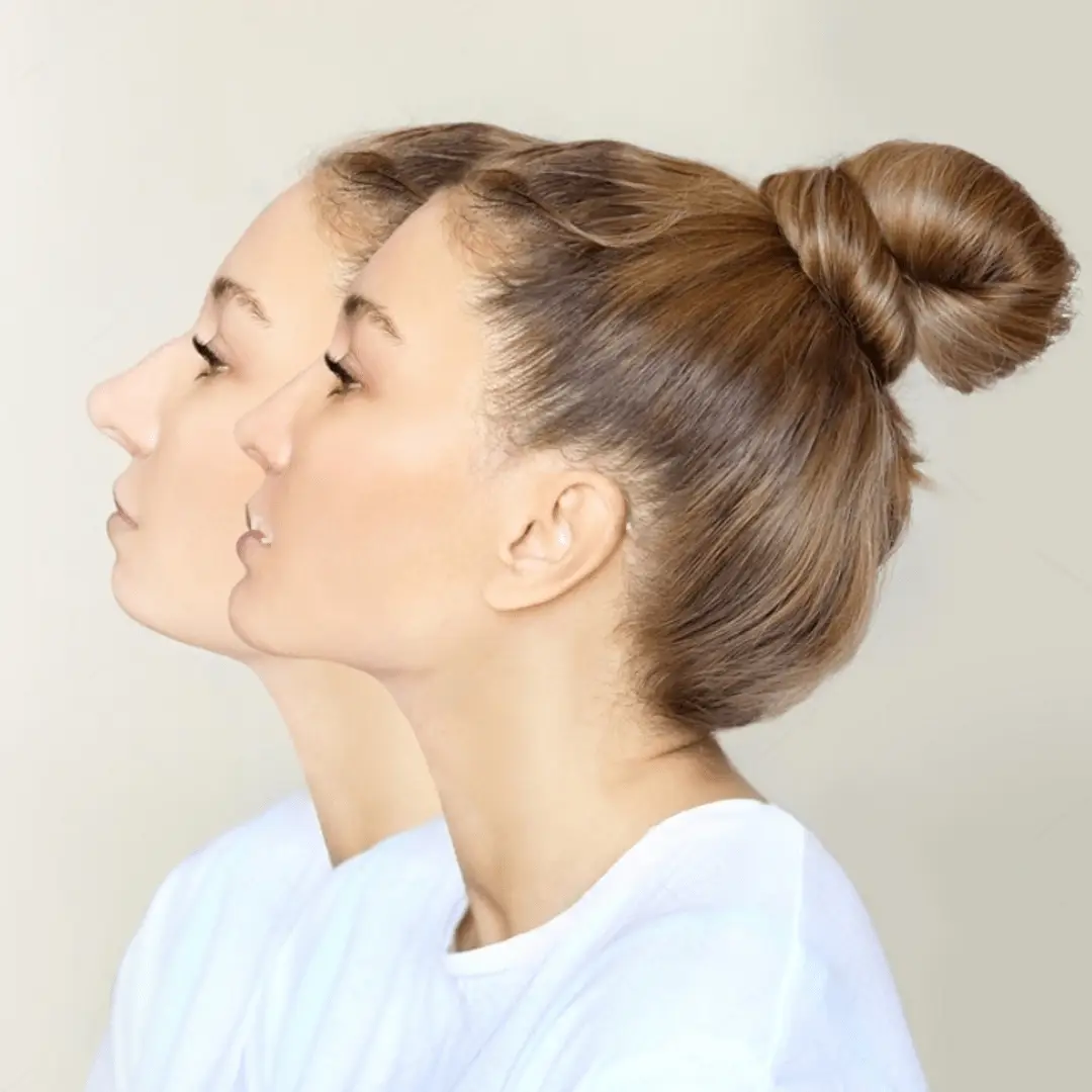 Chin Augmentation - Uks Derma